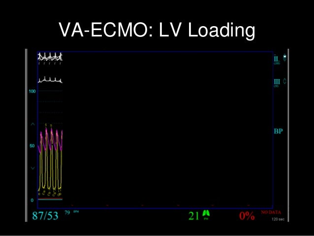 Va Ecmo Lv Venting | Paul Smith