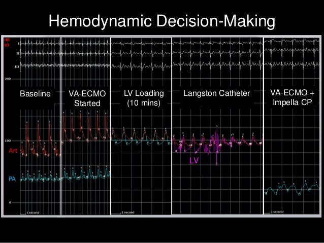 Va Ecmo With Lv Vent | semashow.com