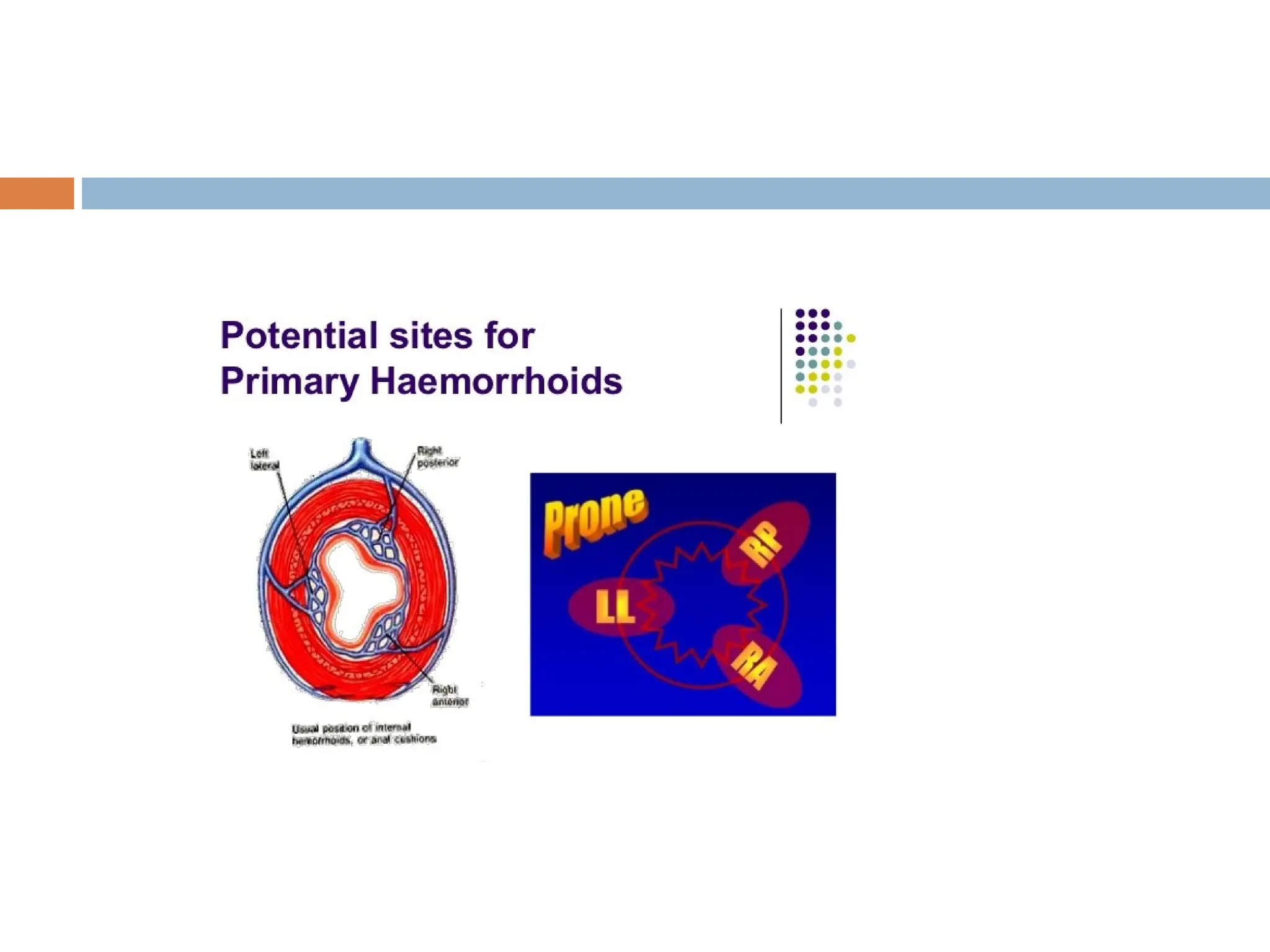 Milligan and Morgan procedure.ppt for doctors | PPT