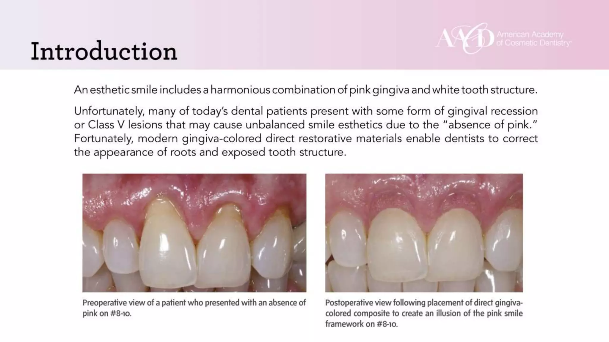 AACD Clinical Tips for Placing Direct Pink Prosthetics Using Gingiva ...