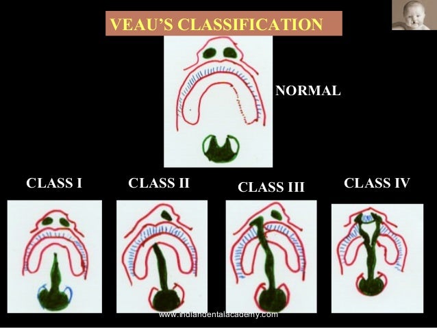 Miltidisciplinary approach fo rehabilitation of cleft lip & palat…