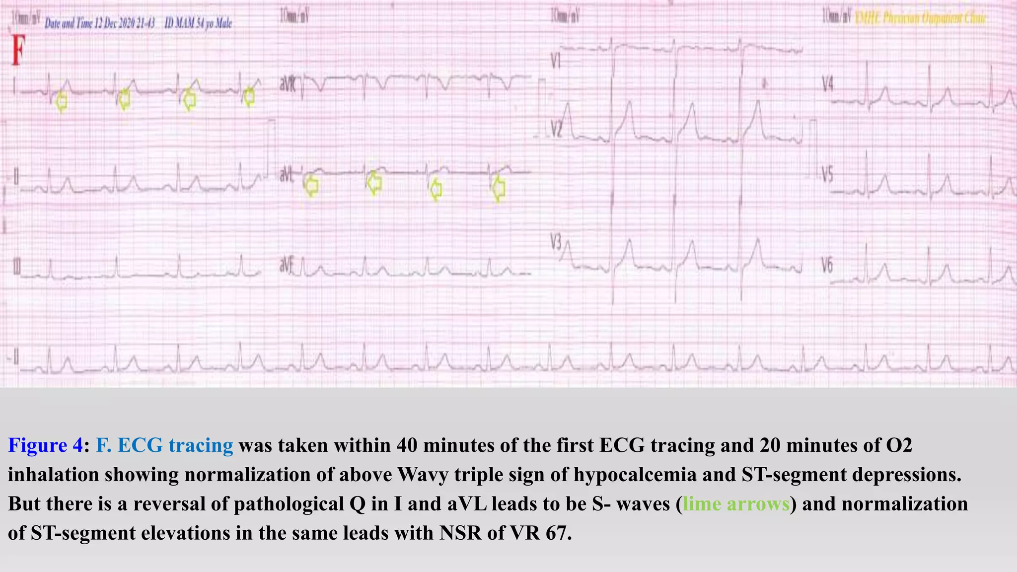 Mimic high lateral myocardial infarction in chest tetany with mirror ...