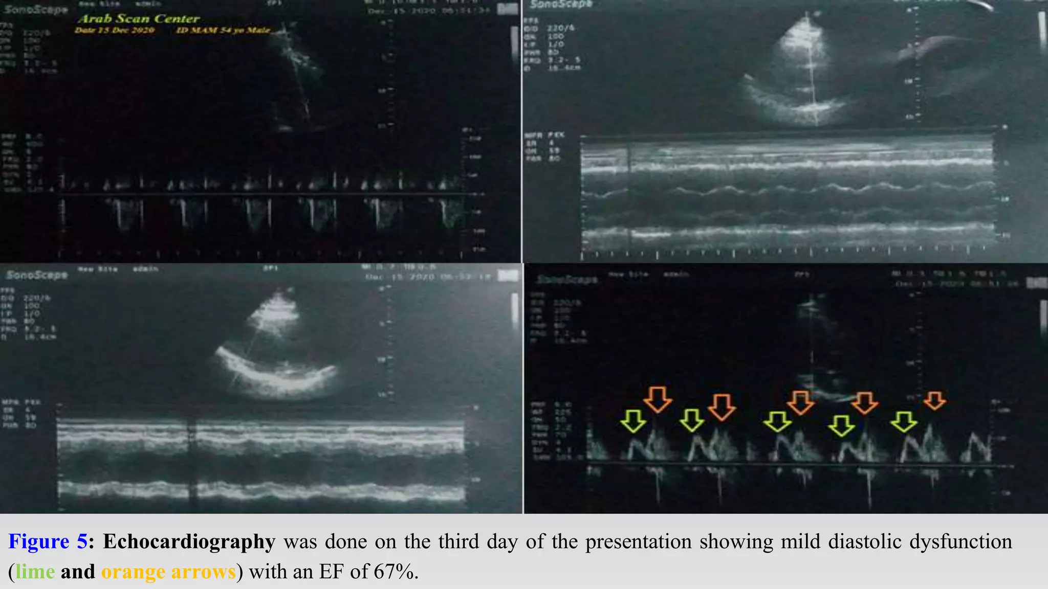 Mimic high lateral myocardial infarction in chest tetany with mirror ...
