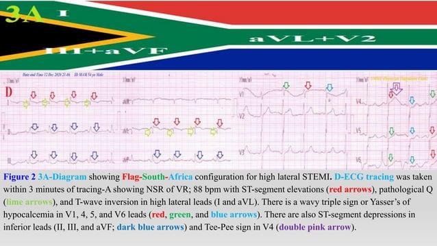 Mimic high lateral myocardial infarction in chest tetany with mirror ...