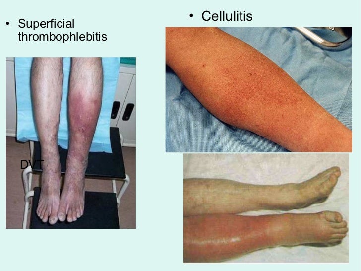 Mimics of infectious_diseases