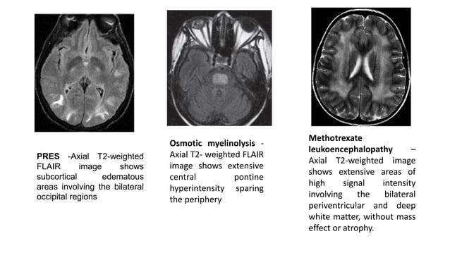 Mimics of MS in MRI copy for neurologist | PPT