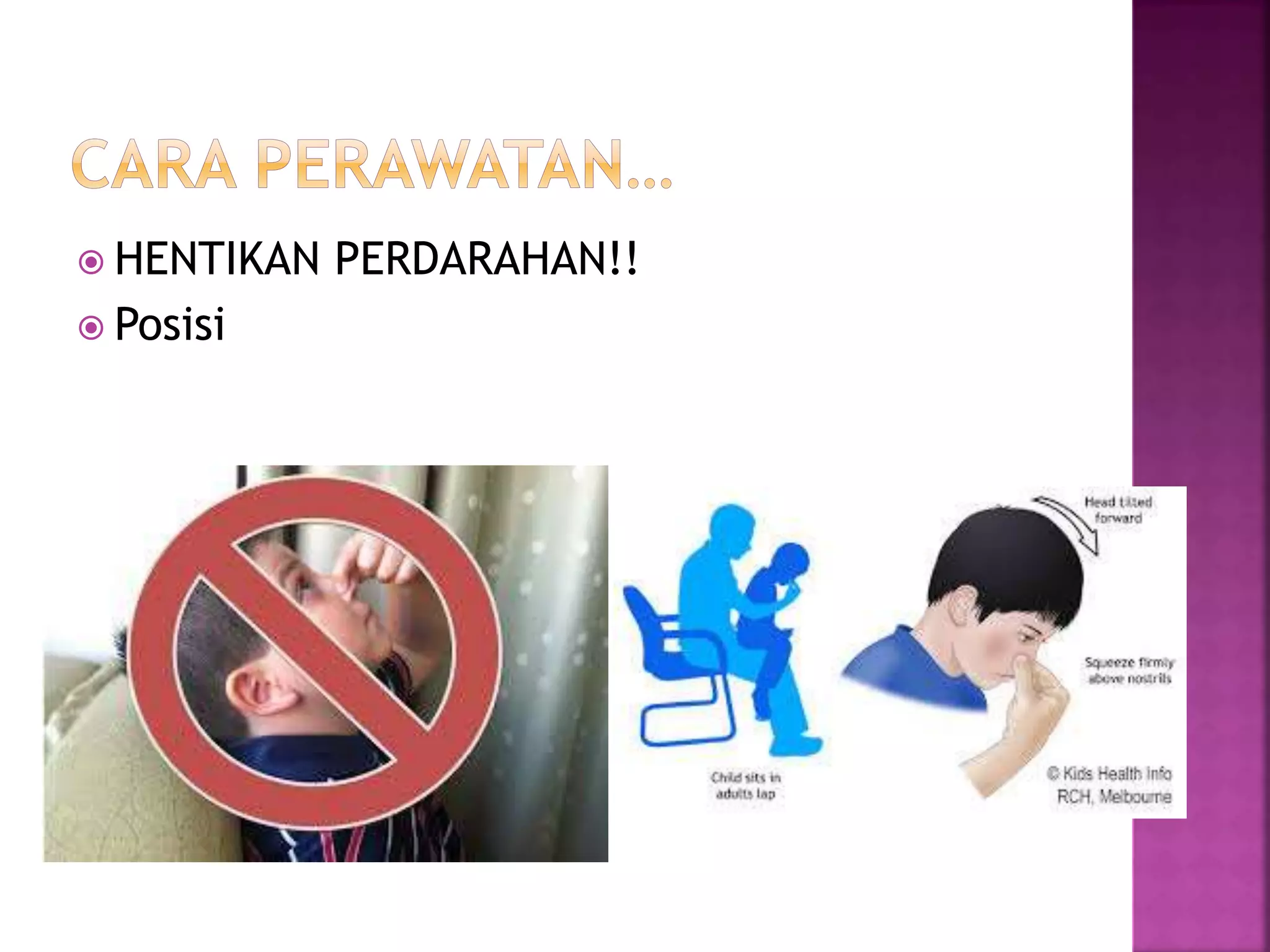 Mimisan (epistaksis) | PPTX
