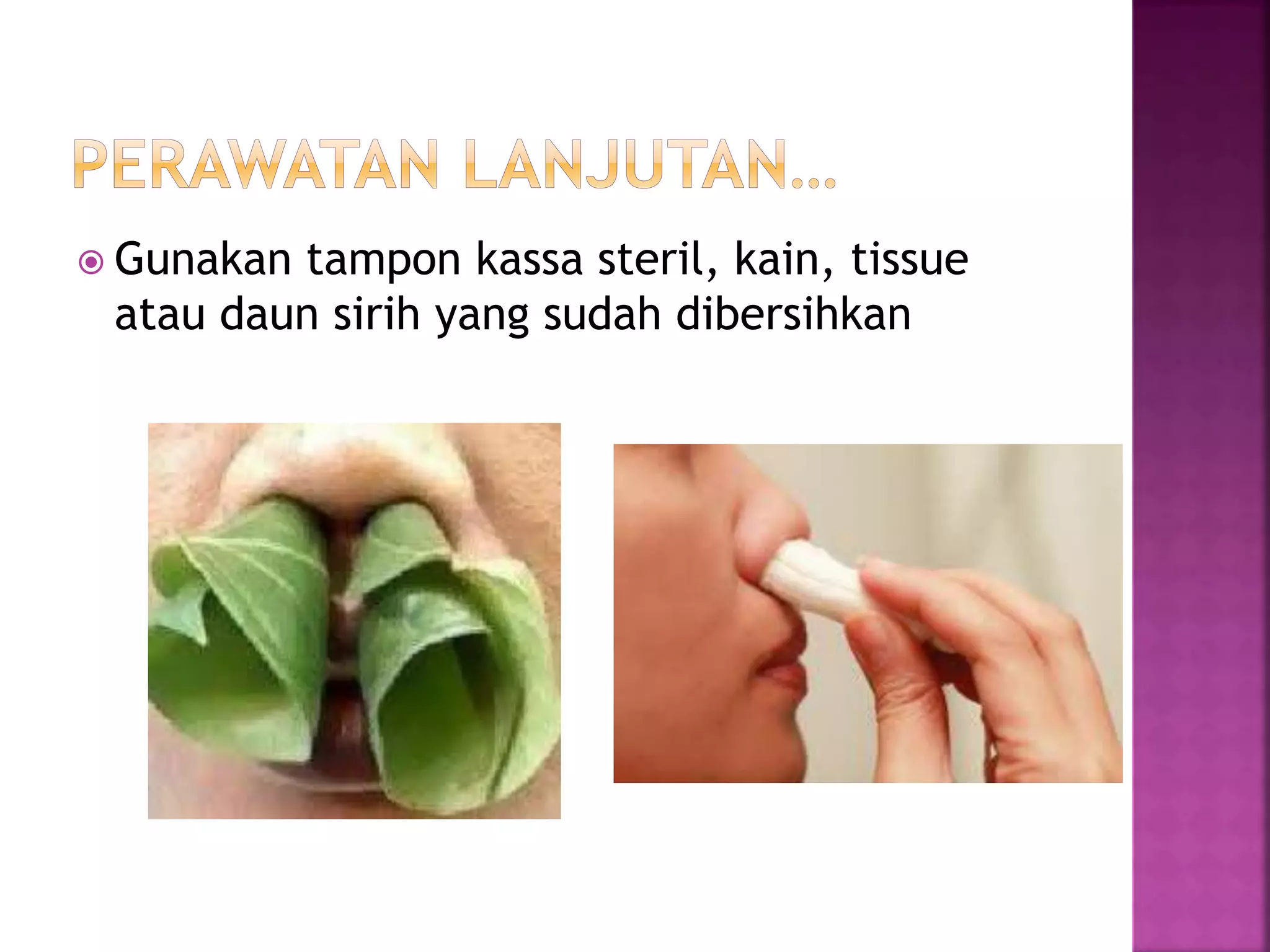 Mimisan (epistaksis) | PPTX