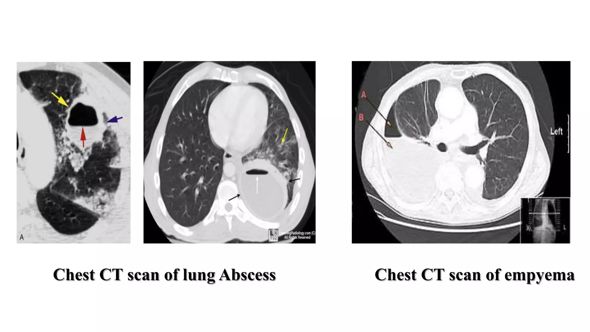 MIM (Lung abscess).pptx
