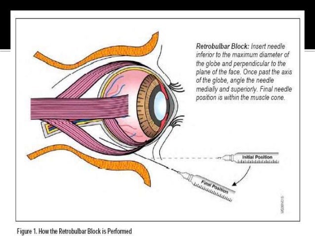 OCULAR Anesthesia