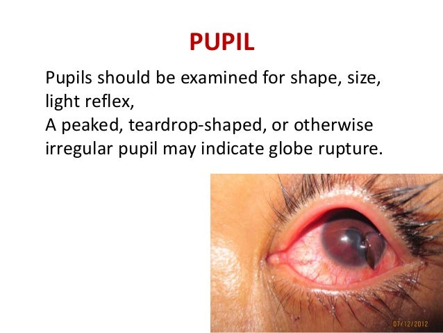 penetrating injury to eye