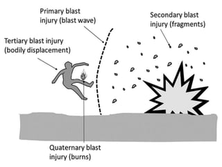Mine blast Injury First Aid | PPTX