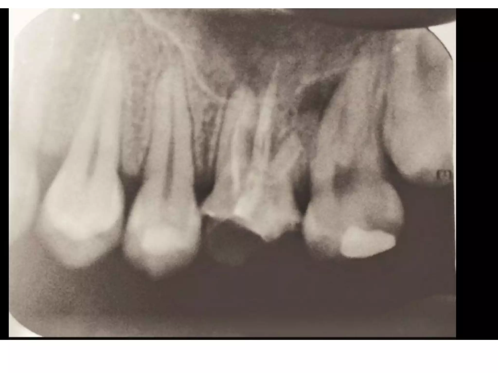 Mineral trioxide aggregate | PPTX