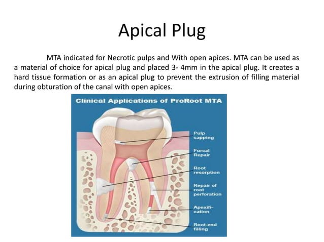 Mineral trioxide aggregate | PPTX | Dental Health | Diseases and Conditions