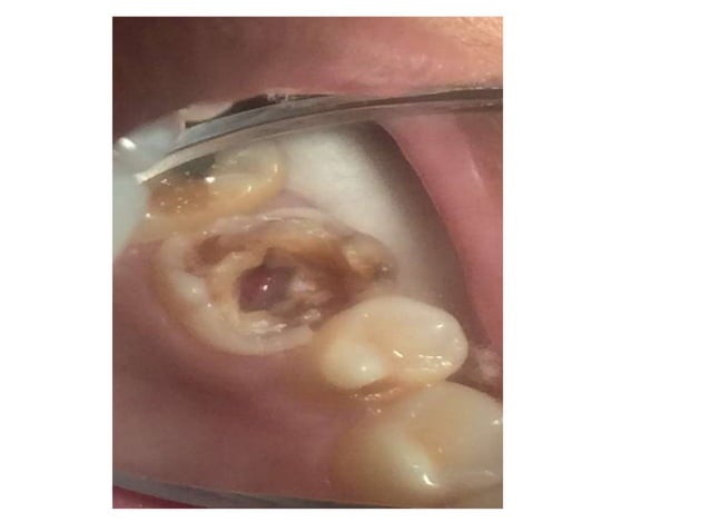 Mineral trioxide aggregate | PPTX | Dental Health | Diseases and Conditions