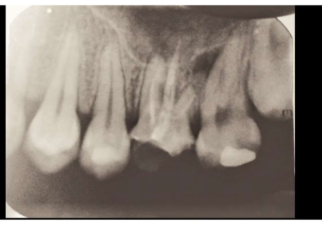 Mineral trioxide aggregate | PPTX | Dental Health | Diseases and Conditions