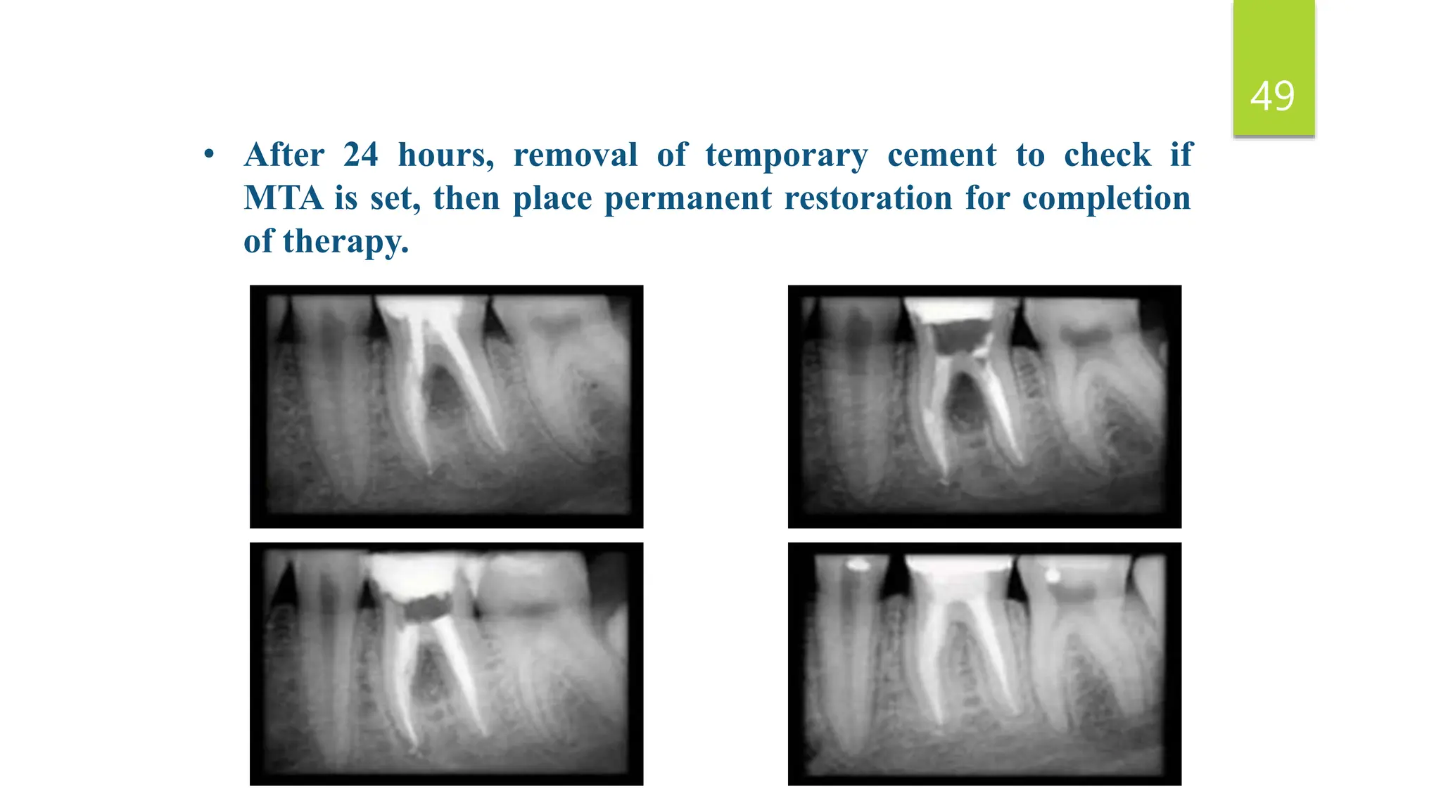 MINERAL TRIOXIDE AGGREGATE presentation.pptx