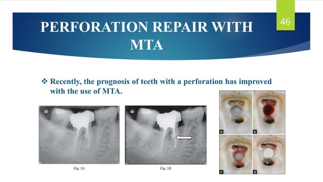 MINERAL TRIOXIDE AGGREGATE presentation.pptx