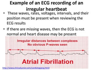 Electrocardiogram (ECG or EKG) | PPTX