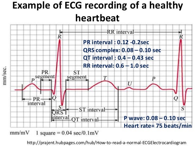 Electrocardiogram (ECG or EKG)