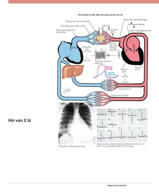 Minh họa hẹp/hở van tim | PDF