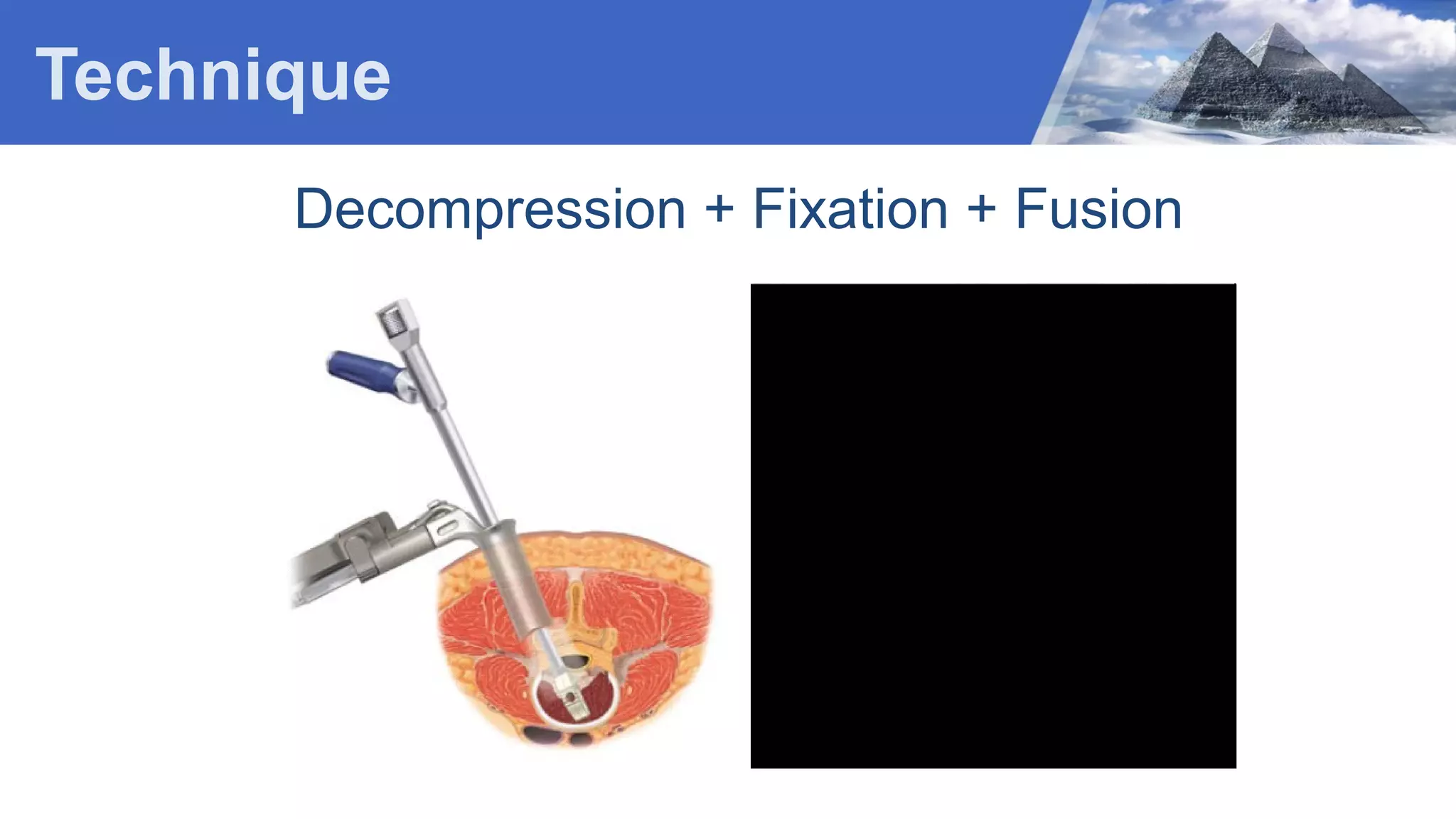 Mini open TLIF | PPT