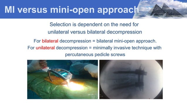 Mini open TLIF | PPT