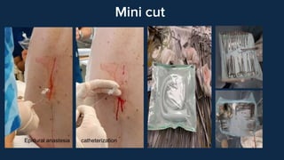 MINI CUT a modern approach to laparotomy. | PPT