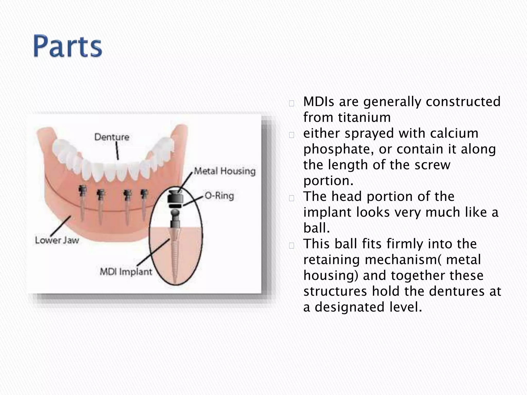 Mini dental implants | PPT