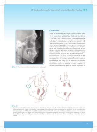 IZC Bone Screw Anchorage for Conservative Treatment of Bimaxillary ...
