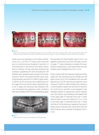IZC Bone Screw Anchorage for Conservative Treatment of Bimaxillary ...