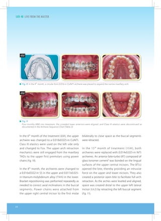 IZC Bone Screw Anchorage for Conservative Treatment of Bimaxillary ...