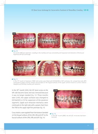 IZC Bone Screw Anchorage for Conservative Treatment of Bimaxillary ...