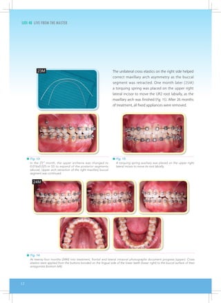 IZC Bone Screw Anchorage for Conservative Treatment of Bimaxillary ...