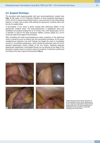 Minilaparoscopy cholecystectomy and hernia repair | PDF