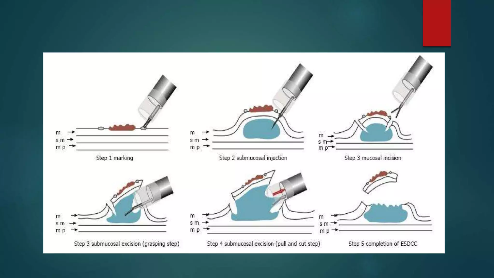 Minimal access surgery | PPTX