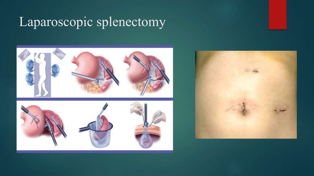 Minimal access surgery | PPTX