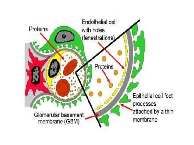 Minimal change disease