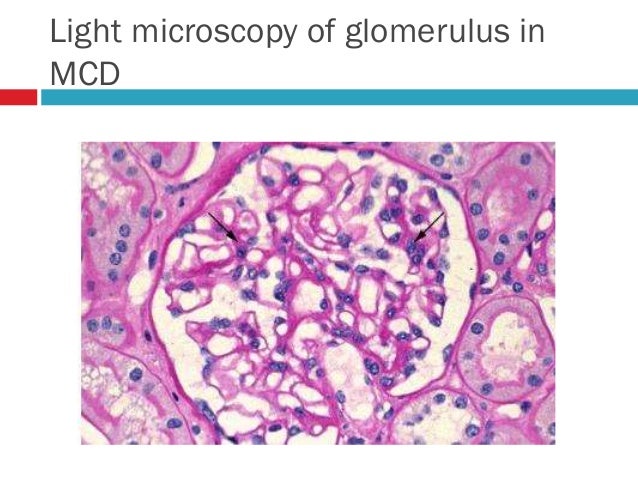 Minimal Change Disease