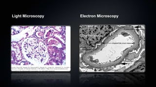 Minimal Change Disease | PPTX