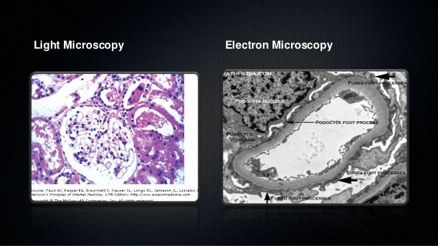 Minimal Change Disease