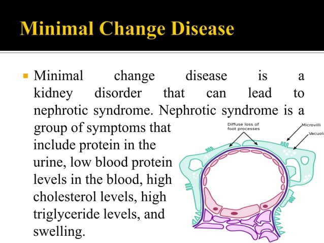 Minimal change disease | PPTX | Diseases and Conditions | Medical Health