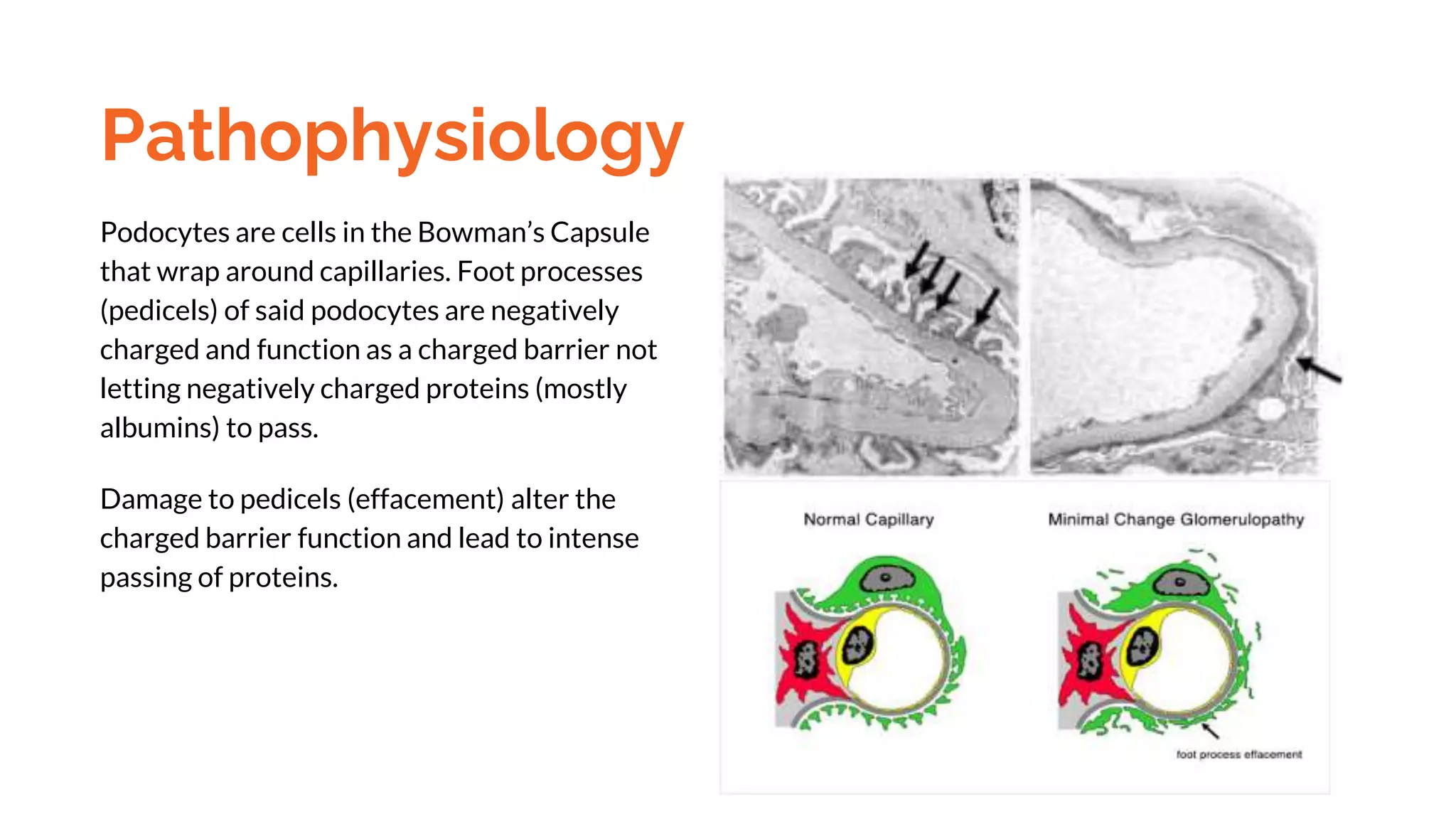 Minimal Change Disease.pptx | Diseases and Conditions | Medical Health