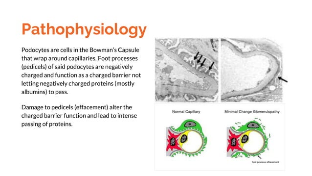 Minimal Change Disease.pptx | Diseases and Conditions | Medical Health