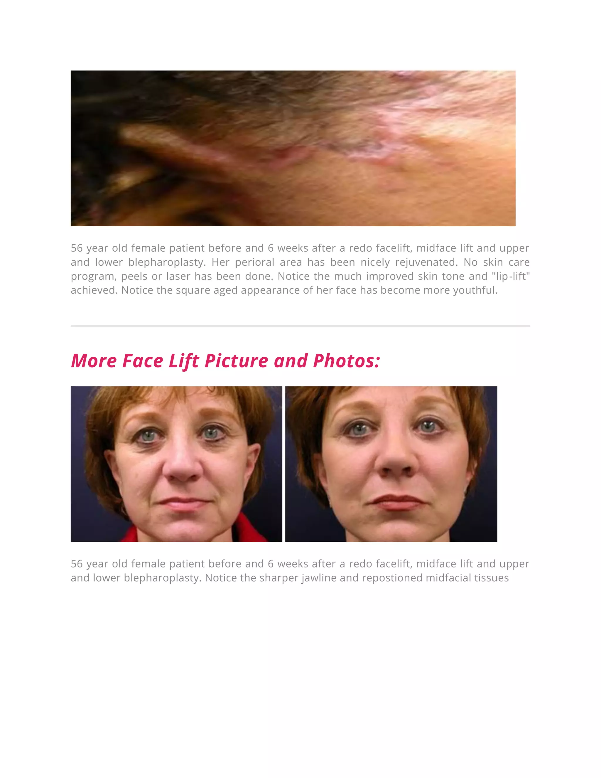 Minimal Incision Facelift Surgery and Lower Face Lift Incisions | PDF