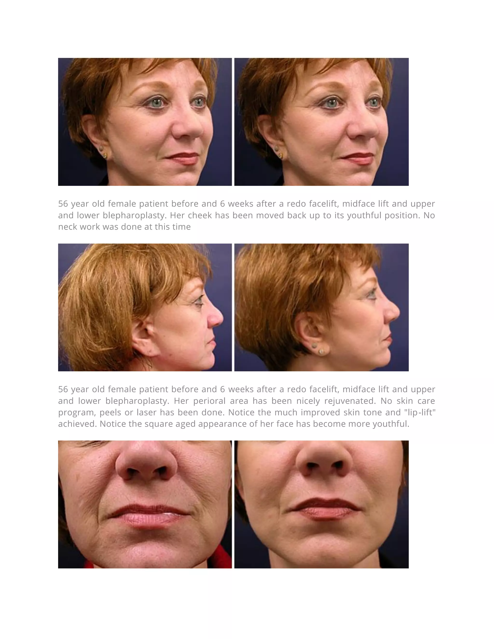 Minimal Incision Facelift Surgery and Lower Face Lift Incisions | PDF