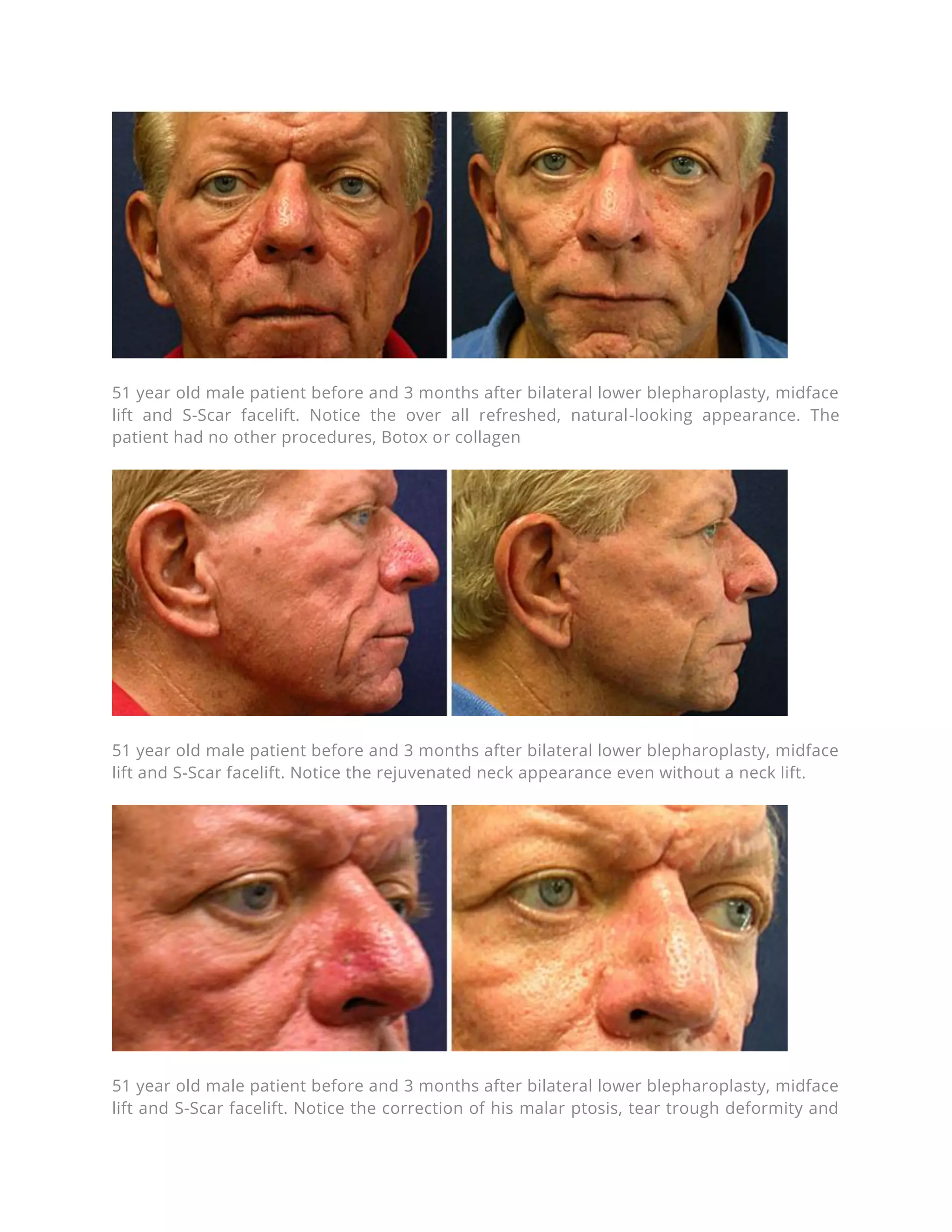 Minimal Incision Facelift Surgery and Lower Face Lift Incisions | PDF