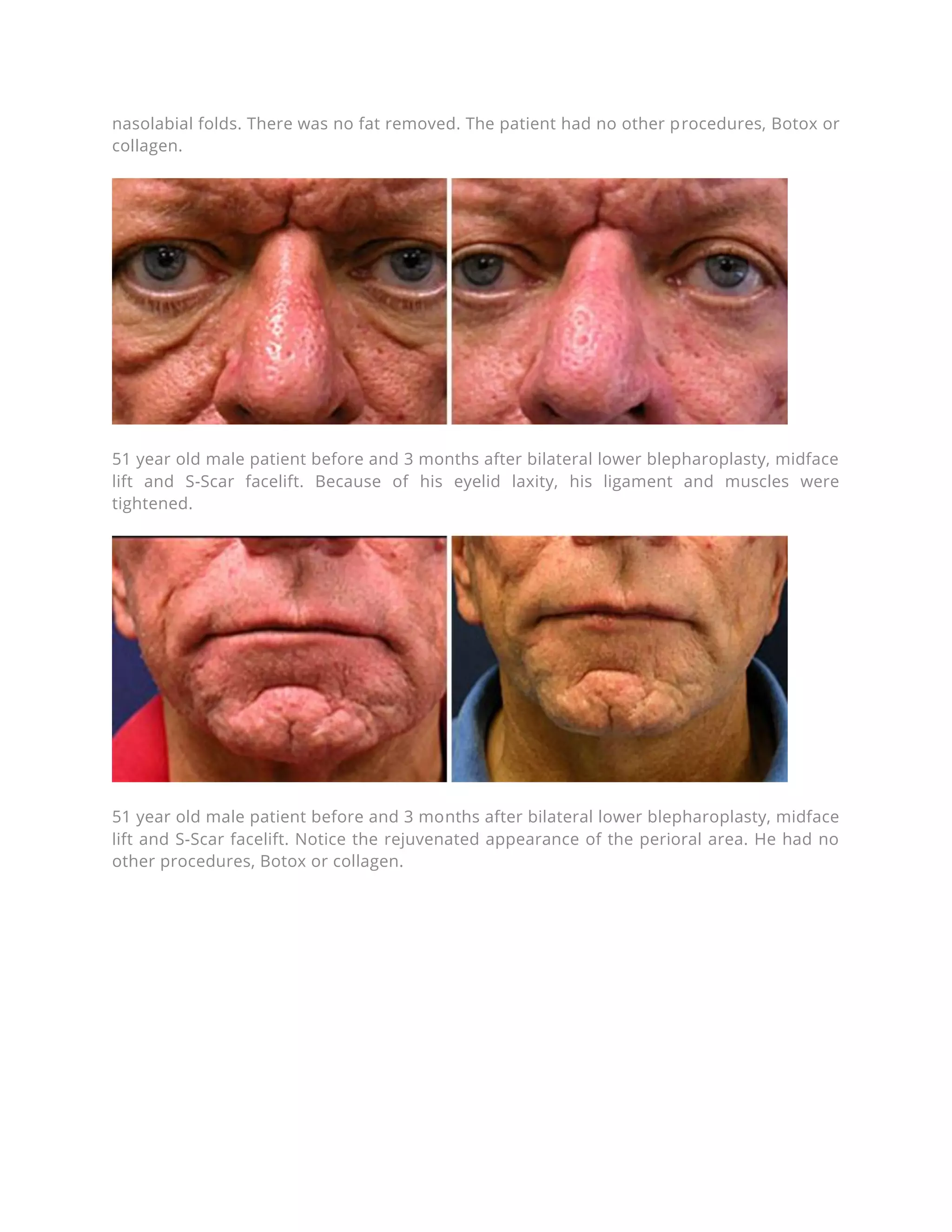 Minimal Incision Facelift Surgery and Lower Face Lift Incisions | PDF