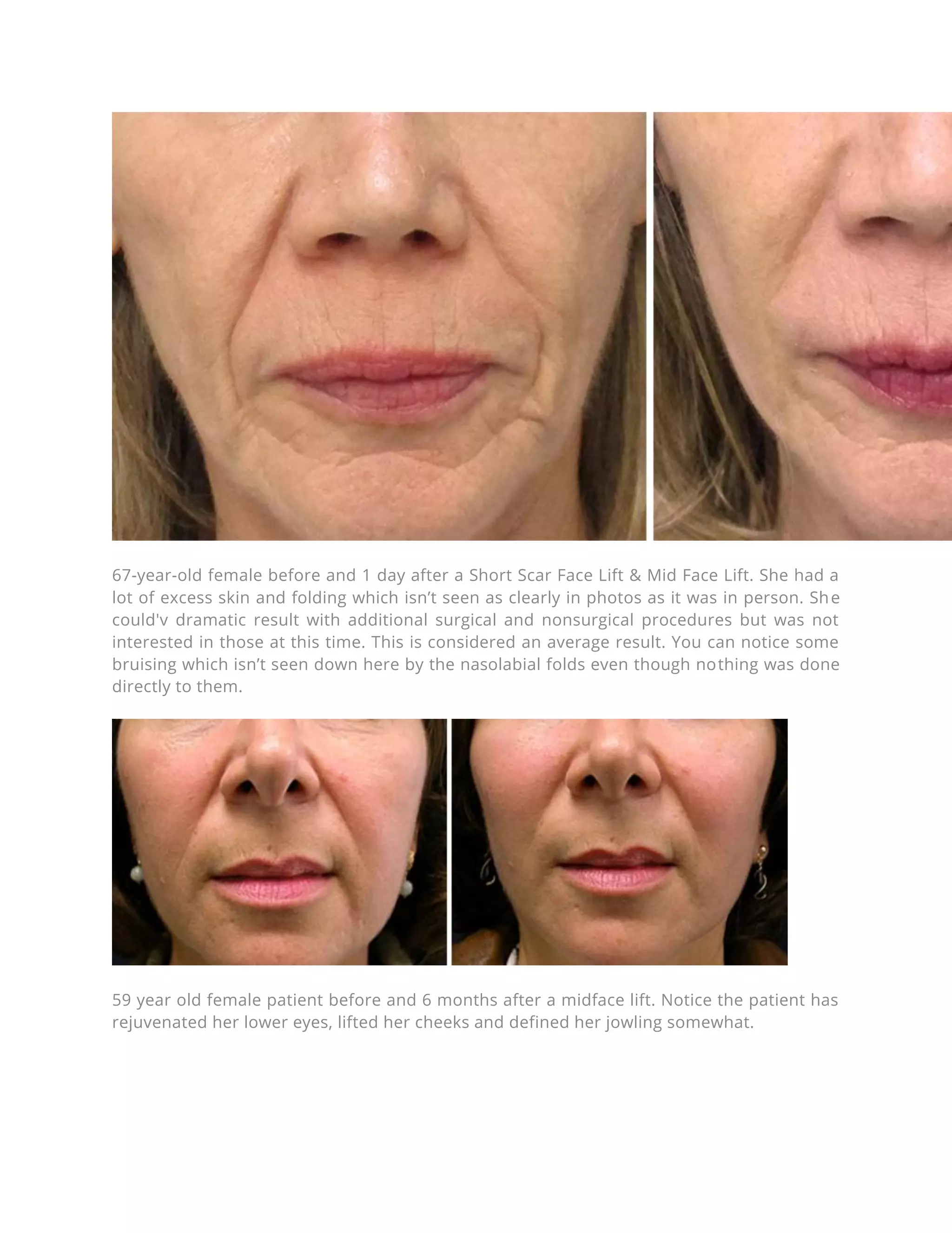Minimal Incision Facelift Surgery and Lower Face Lift Incisions | PDF