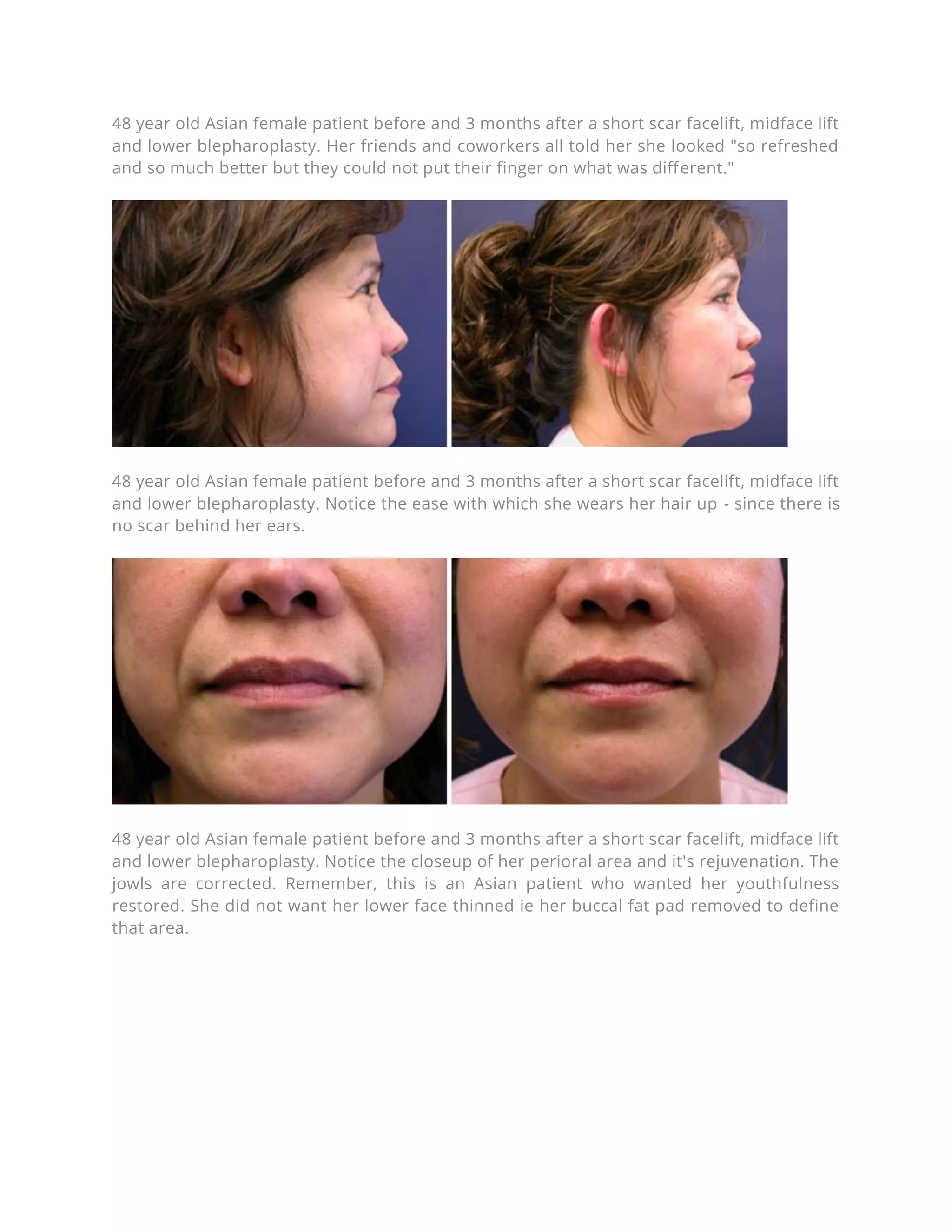 Minimal Incision Facelift Surgery and Lower Face Lift Incisions | PDF
